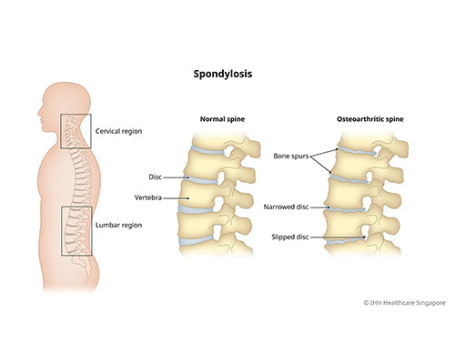 Cervical & Lumbar Spondylosis Explained – Healthy Options